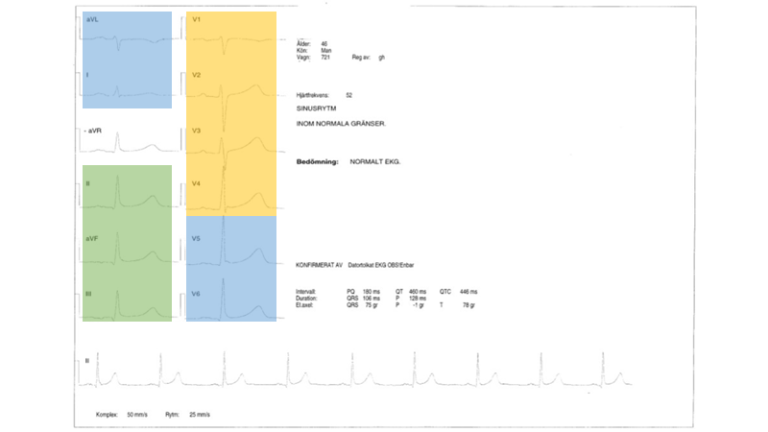 Tid til paradigmeskifte: OMI – del 2: Højrisiko patienten og EKG ...